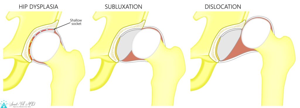 Vector illustration anatomy of a hip joint with dysplasia, subluxation ...