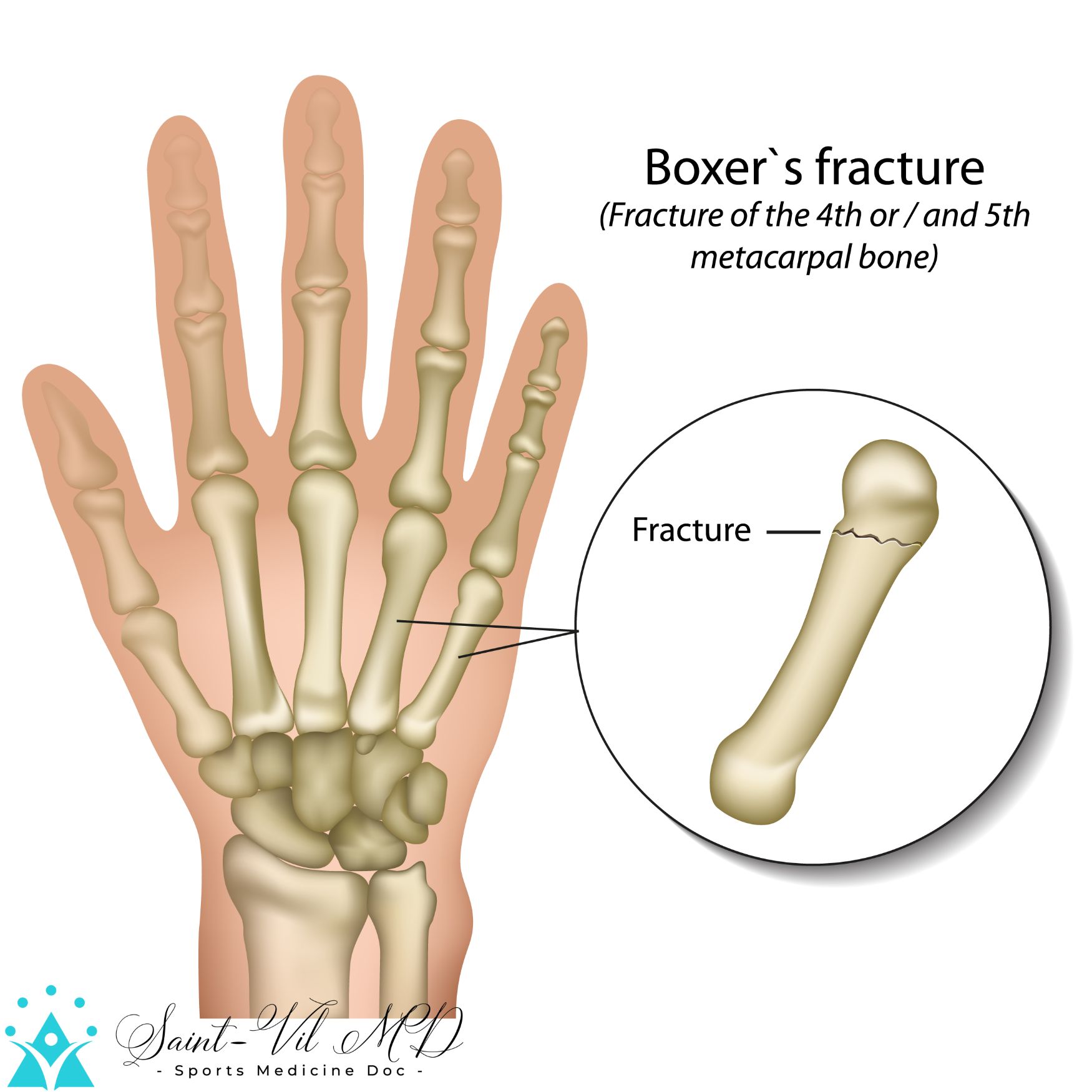 Boxer`s bone hand fracture medical vector illustration - ExerciseNow
