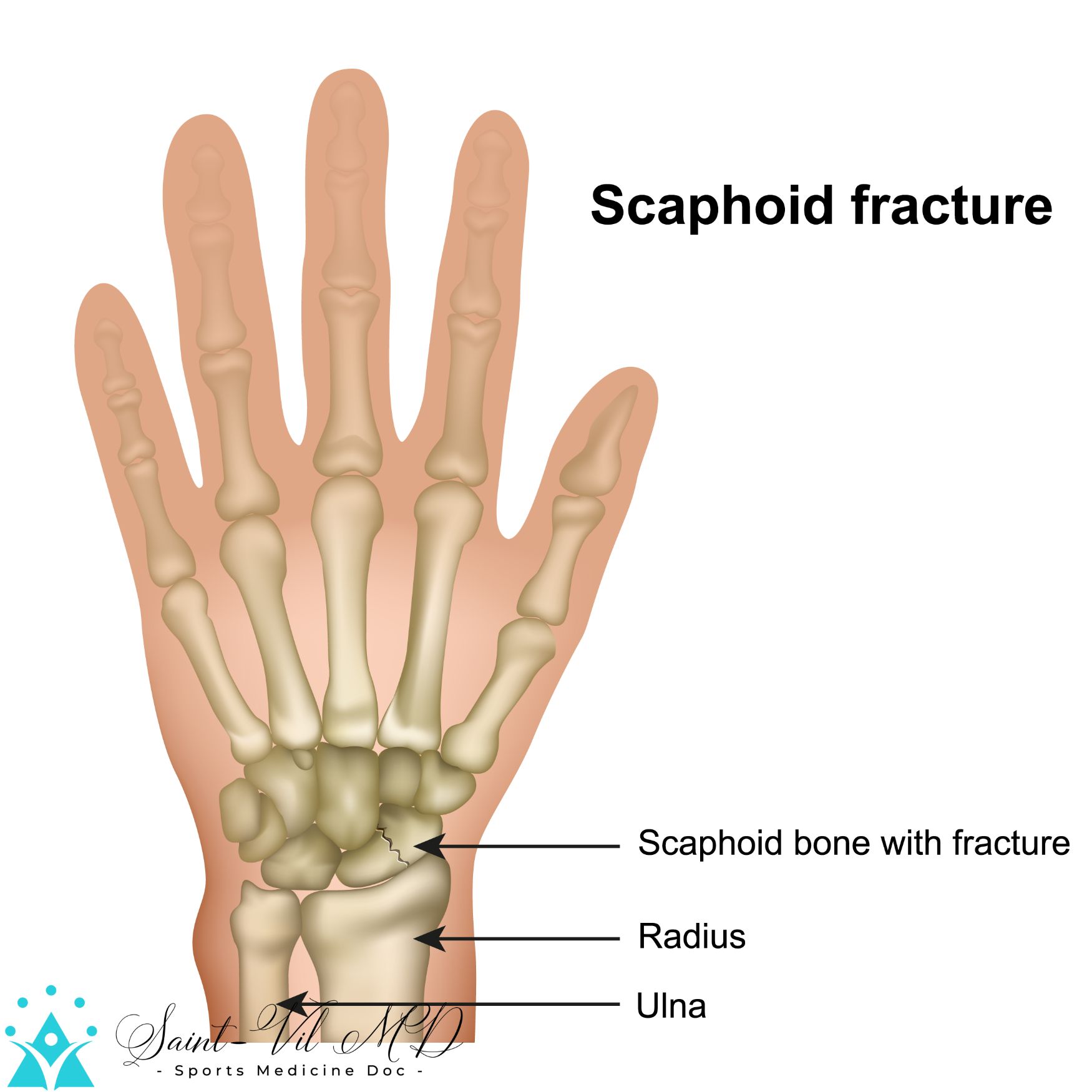 Scaphoid bone fracture medical vector illustration on white background ...