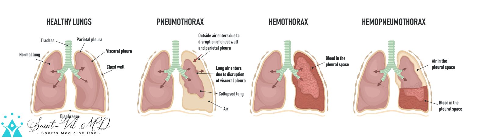 Human lungs with pneumothorax, hemothorax and hemopneumothorax ...