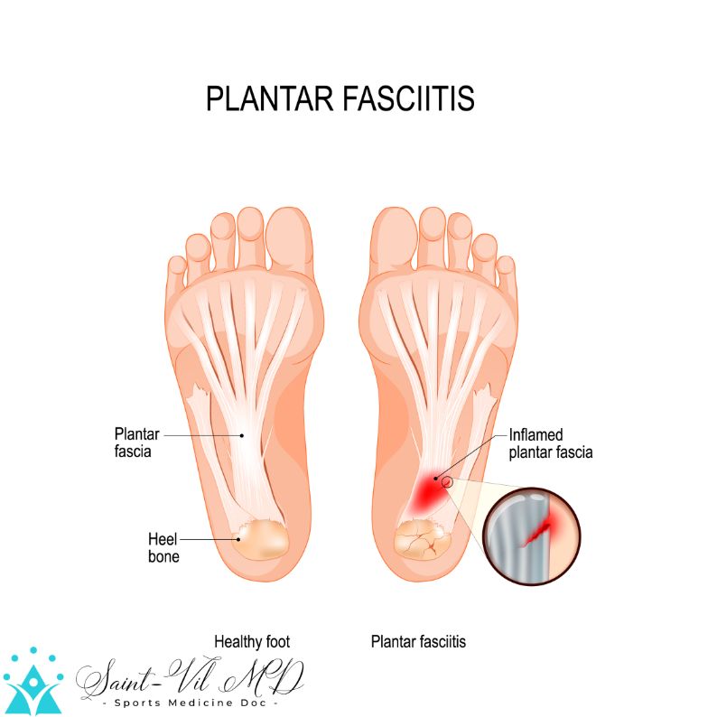 Plantar fasciitis. disorder of the connective tissue which supports the arch of the foot. vector ...