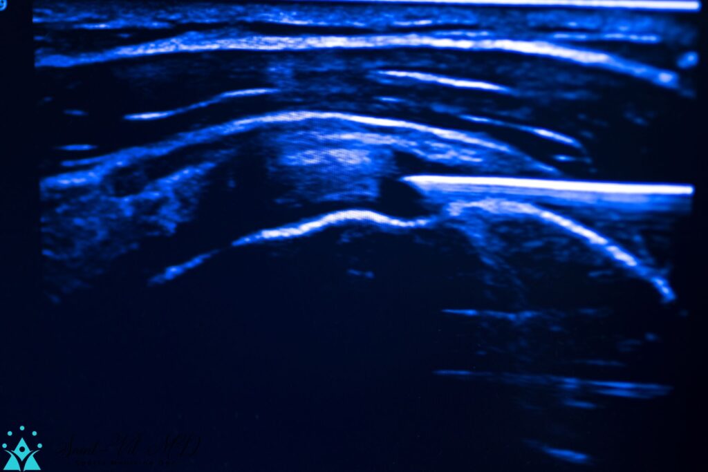 EPI Intratissue Percutaneous Electrolysis dry needling ultrasound ...