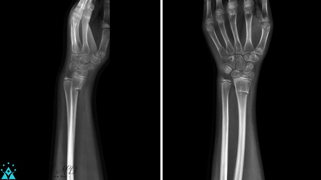 Film X ray wrist radiograph show wrist bone broken (torus or buckle ...