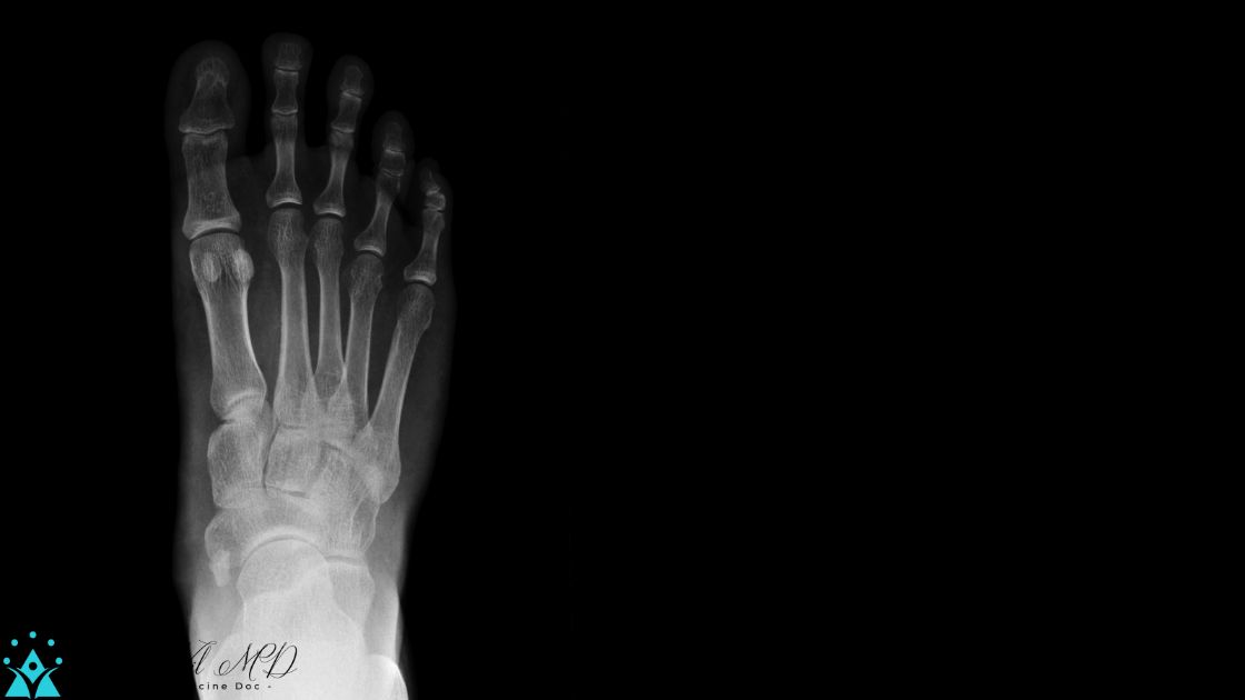 Film X ray radiograph show accessory navicular bone (os navicularum or ...