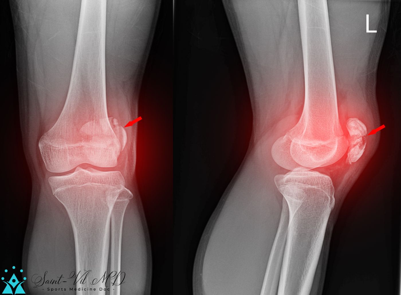 Knee joint x-ray(AP and LATERAL) view fracture and displacement of the ...