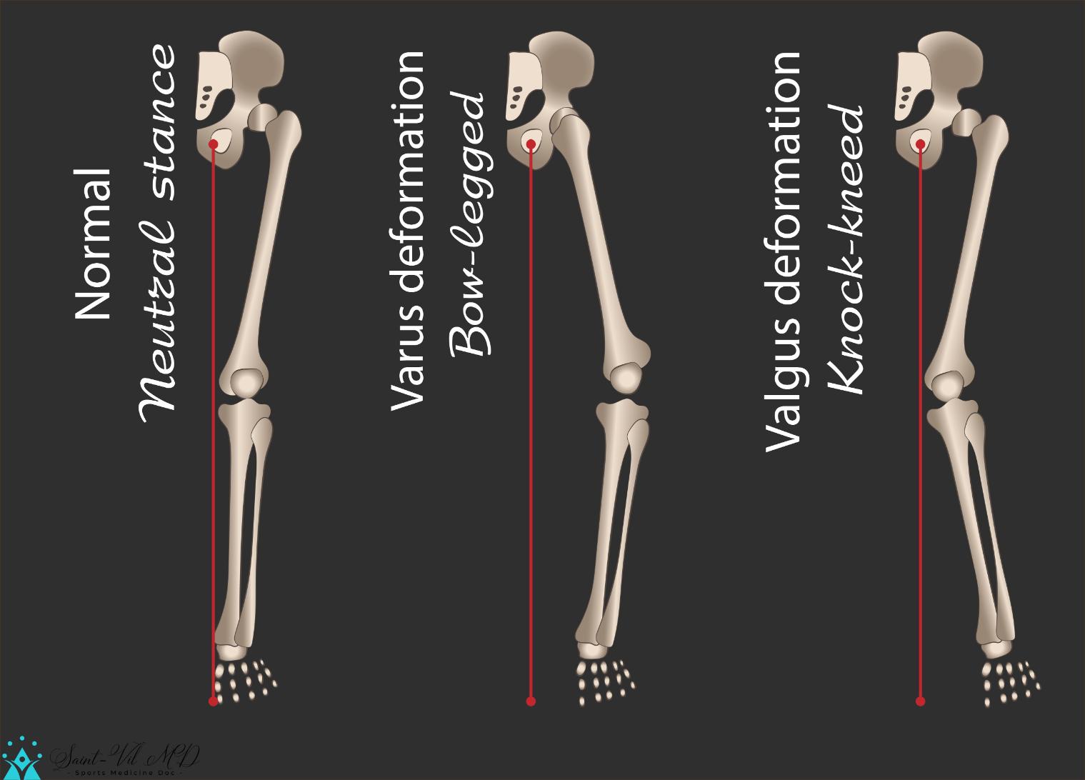 Medical poster. Normal legs, varus and valgus deformity of the legs ...
