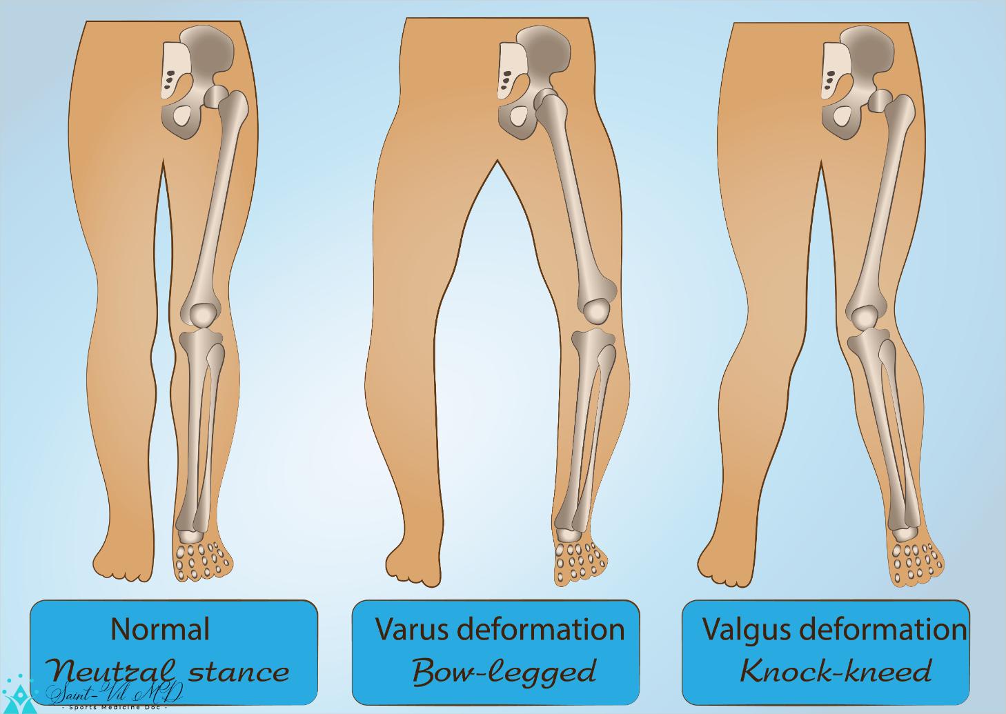Medical poster. Normal legs, varus and valgus deformity of the legs ...
