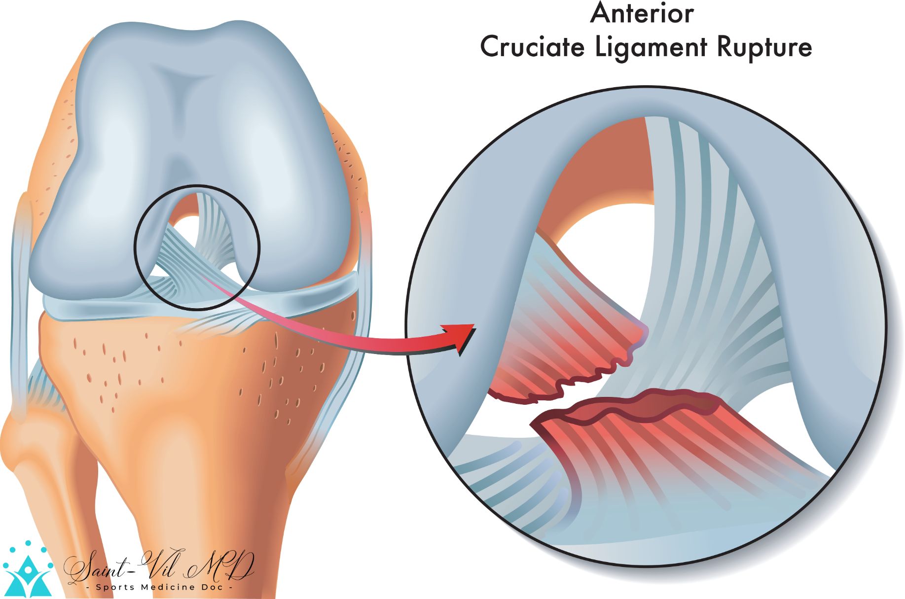 Medical Illustration of anterior cruciate ligament rupture. - ExerciseNow