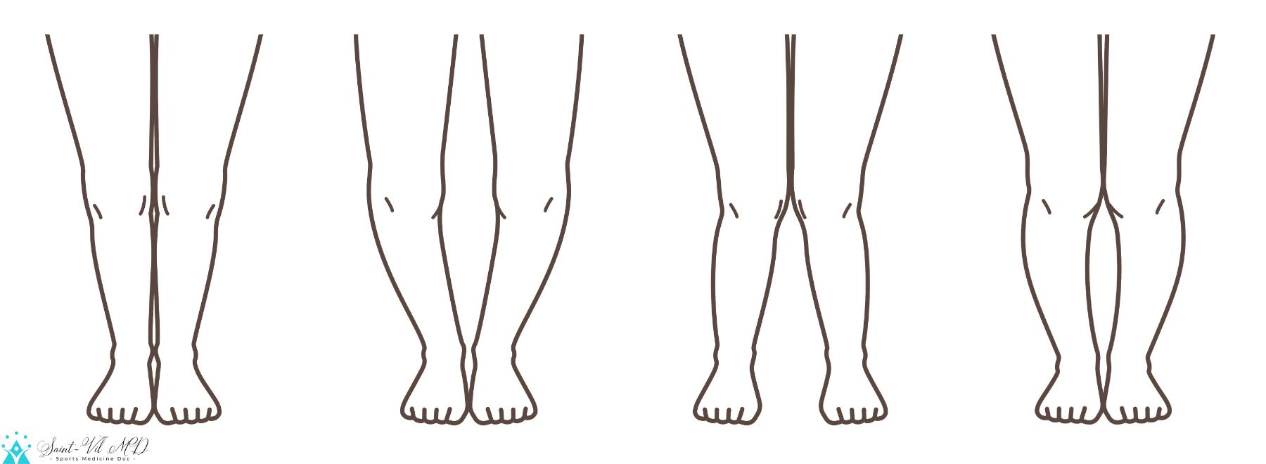 Illustrations for explaining about leg condition. - ExerciseNow
