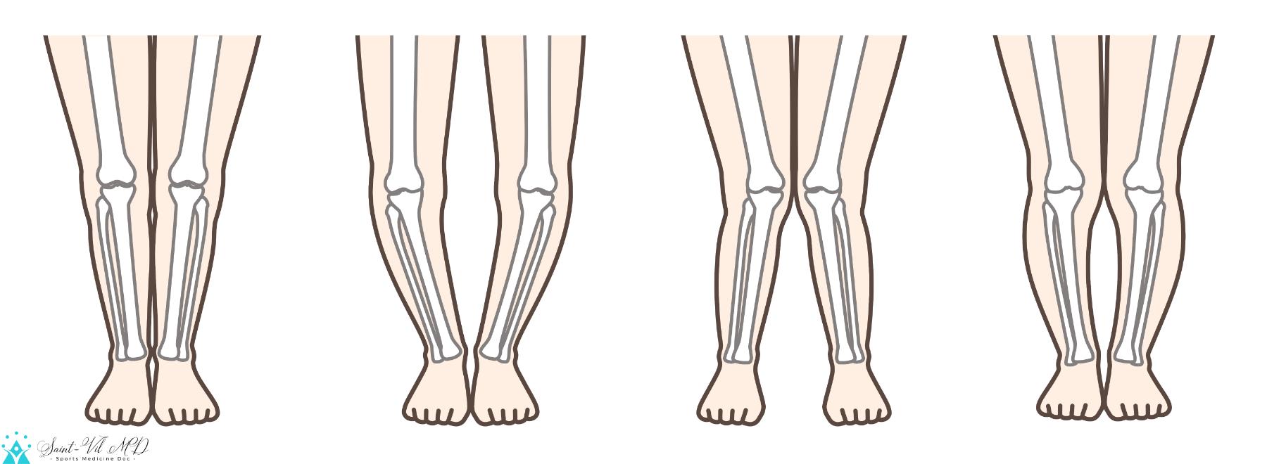 Illustrations for explaining about leg condition. - ExerciseNow