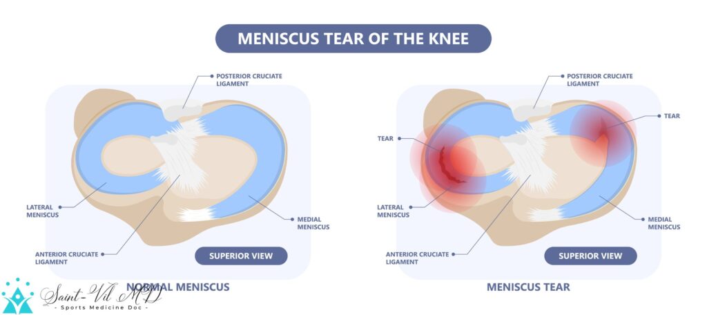 patella pain cap knee tear Torn injury Swelling bone leg exercise ...