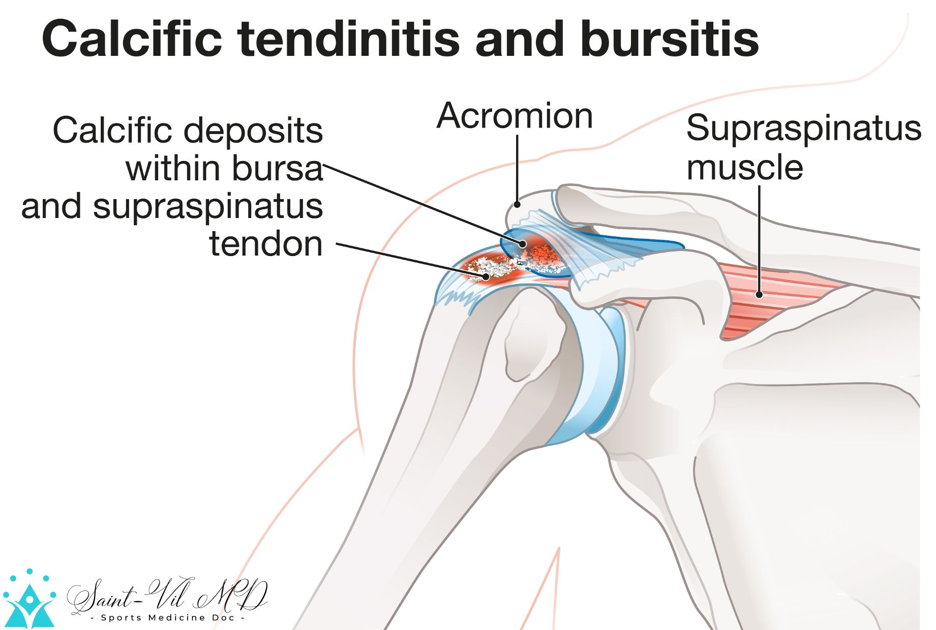 Illustration showing calcific tendinitis and calcific bursitis ...