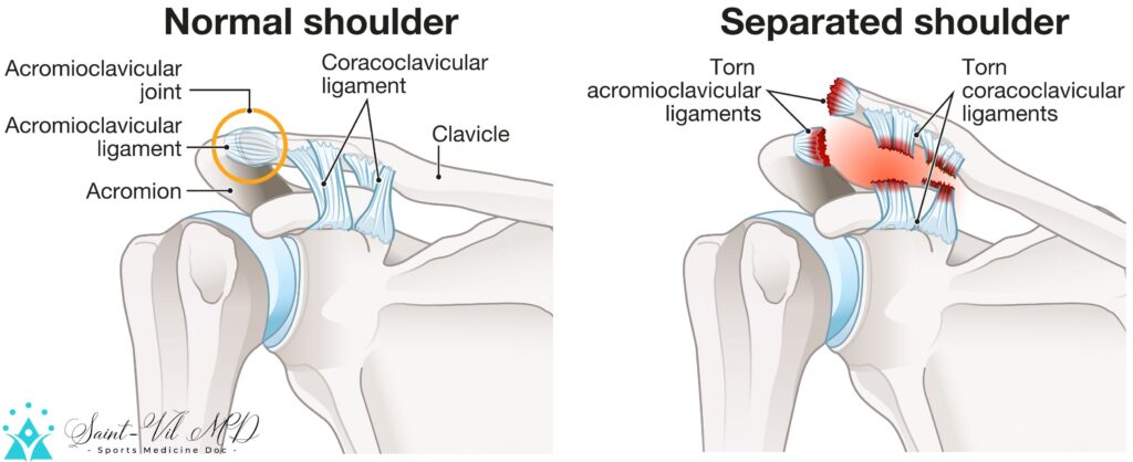 Illustration showing acromioclavicular joint separation or AC joint ...