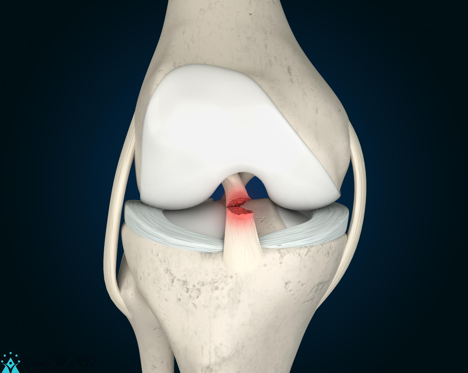Anterior Cruciate Ligament Tear 3D Rendering, ACL Tear, ACL Injury, ACL Rupture, Knee Anatomy ...