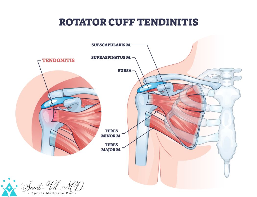 Rotator cuff tendinitis as shoulder muscular inflammation outline diagram. Labeled educational ...