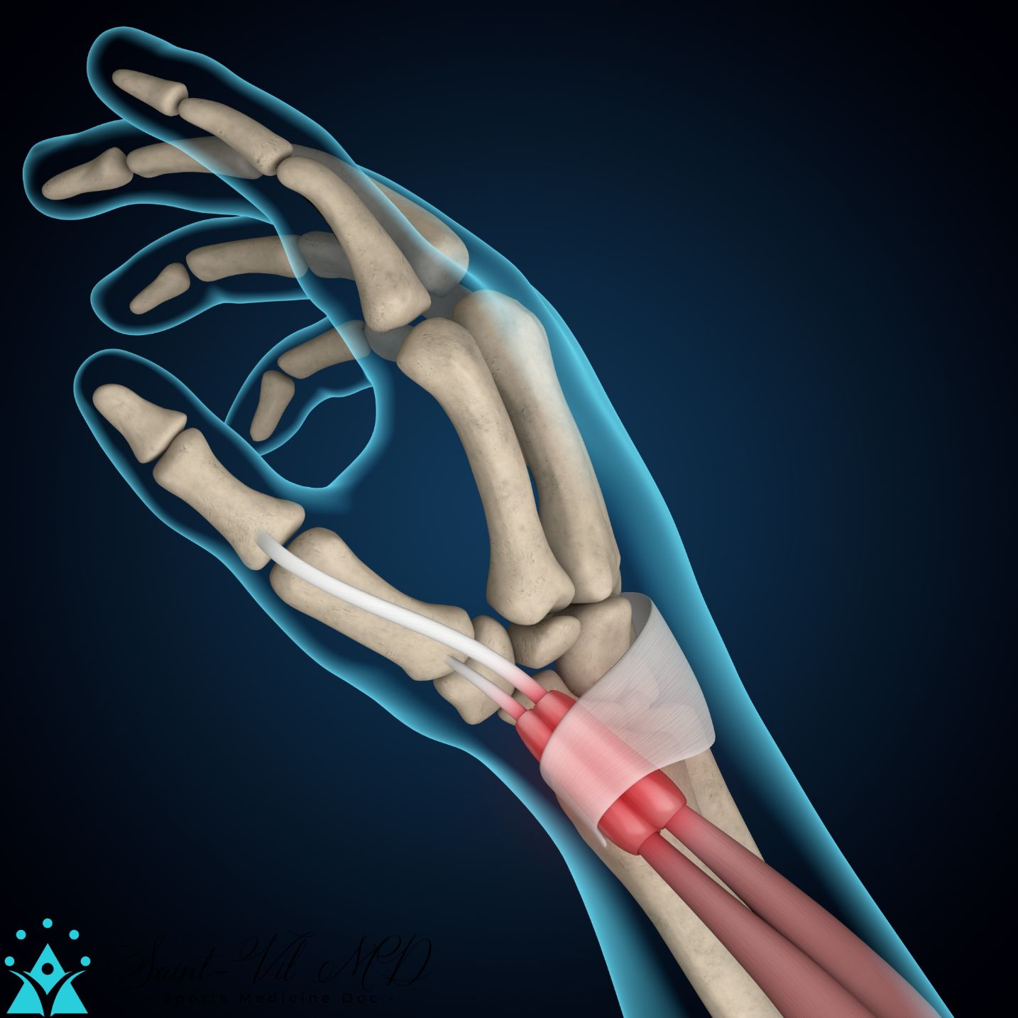 De Quervain's Tenosynovitis 3D Rendering, Mommy's Wrist, Mommy's Thumb ...