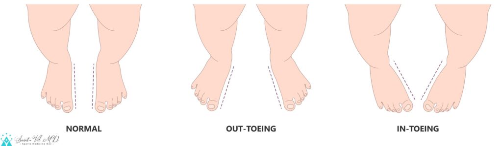 Equinovarus W sit injury bow leg genu valgum varum flat duck out turn ...