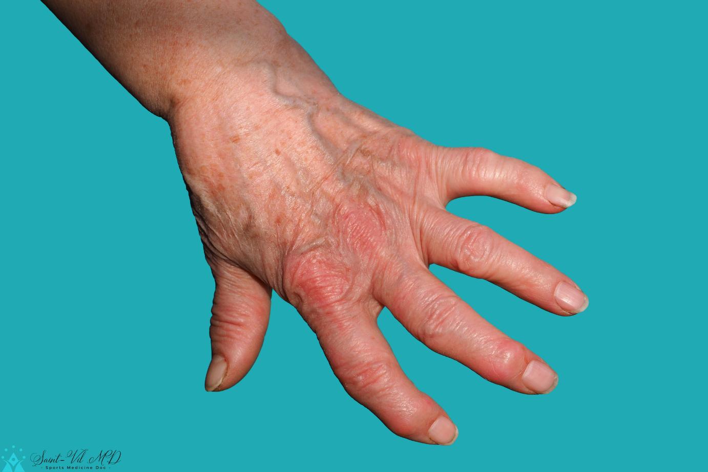 An image of the hand of an elderly woman suffering from arthritis of ...