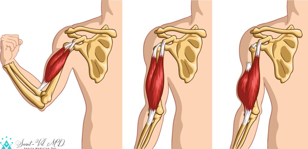 Vector illustration of Human biceps tendon rupture. - ExerciseNow