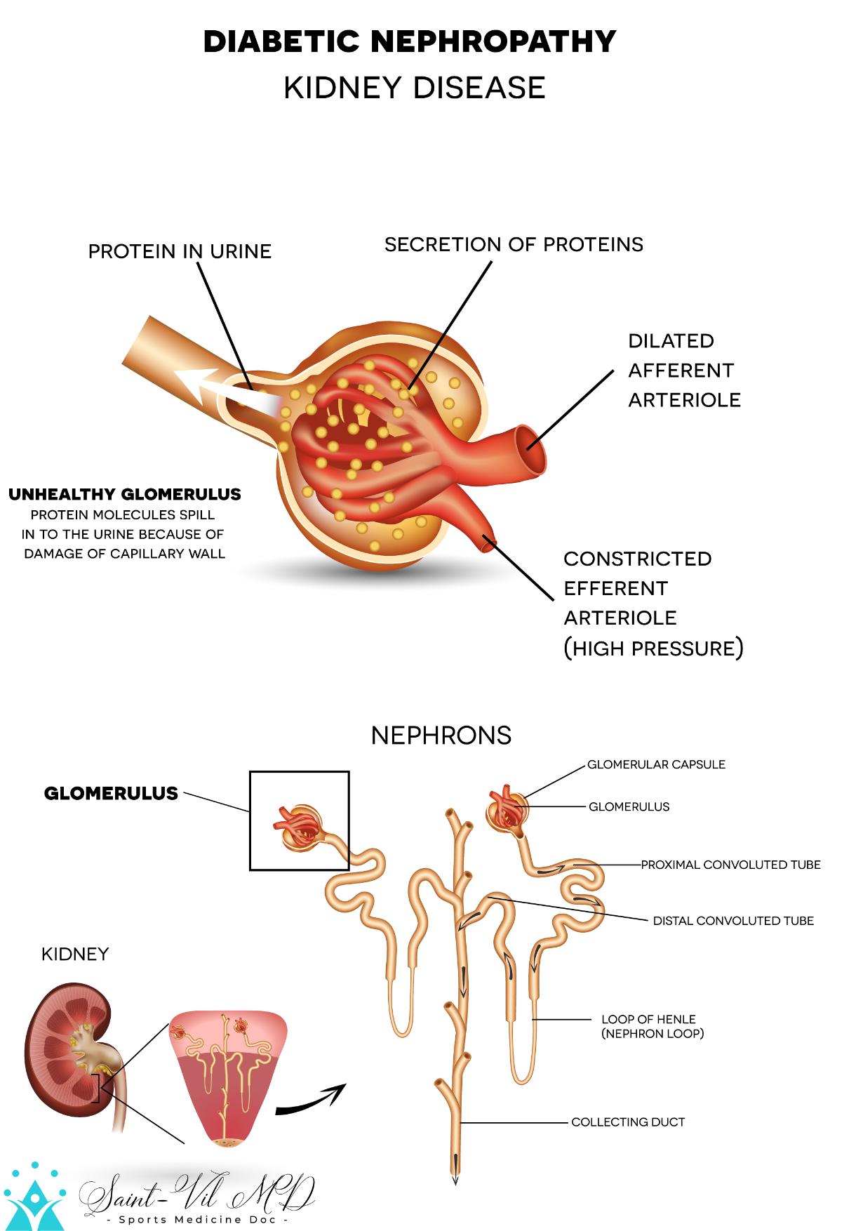 Nephropathy, the damage of glomerulus, kidney disease caused by ...