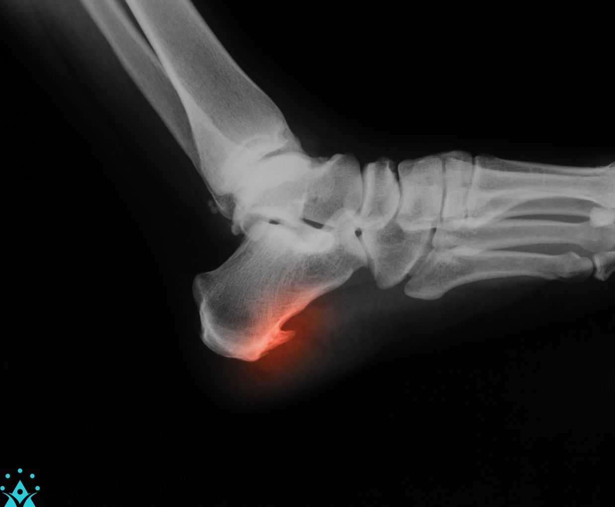 X-ray image of calcaneus shows heel spur syndrome, oblique view ...