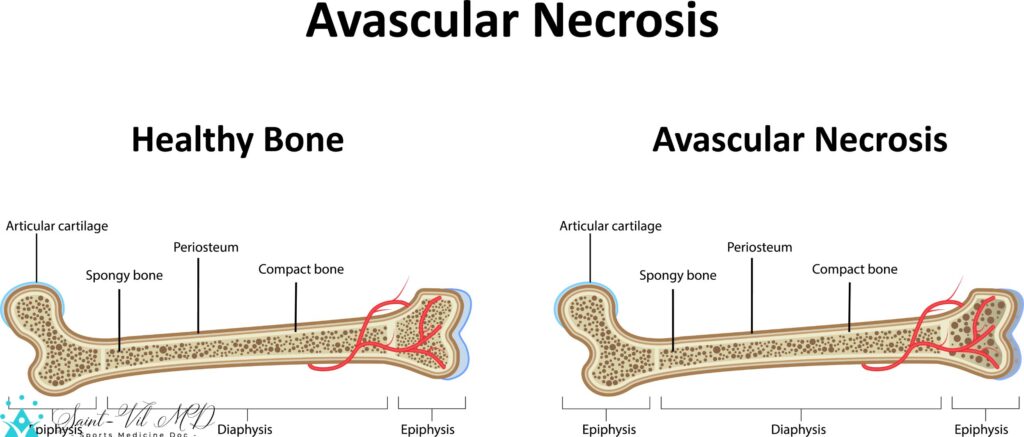 Avascular Necrosis Illustration - ExerciseNow