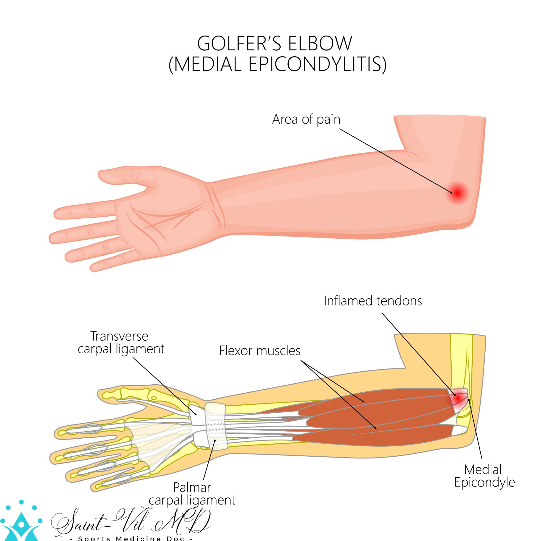 Vector illustration of Medial Epicondylitis or golfer's elbow. Used ...